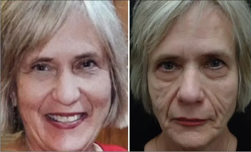 Ozempic Face Before And After - My Family Pride